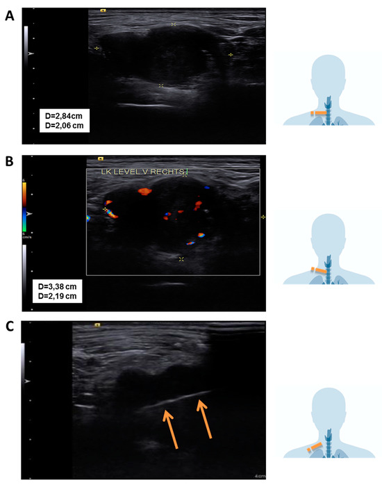 Cutting the Gordian Knot: Rare Presentation of Nodular Fasciitis as ...