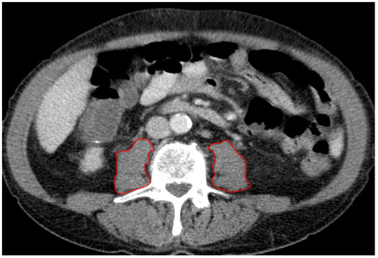 Impact of Psoas Muscle Area Index on Short- and Mid-Term Mortality in ...
