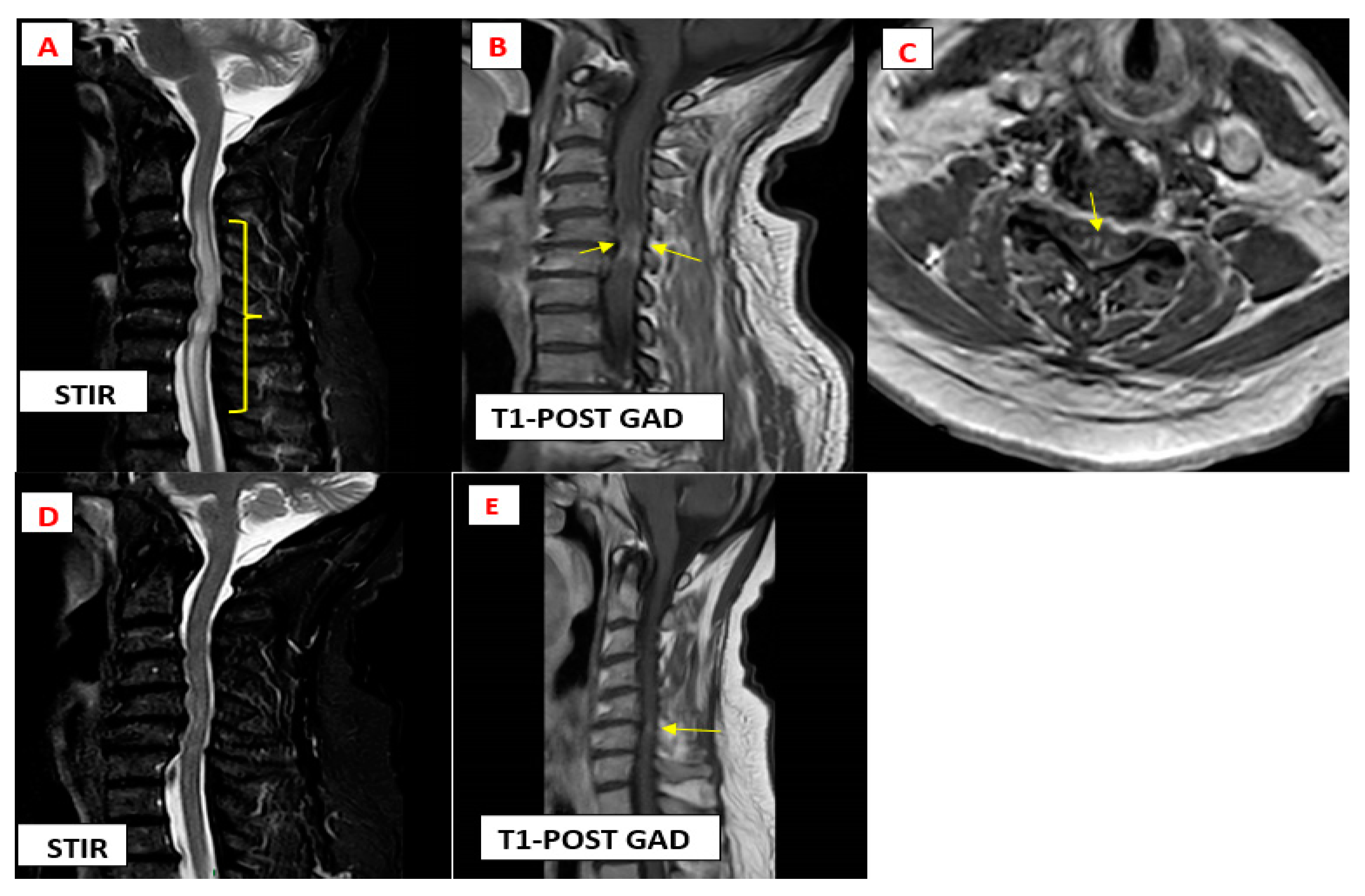 Neurosarcoidosis Masquerading as Spinal Stenosis