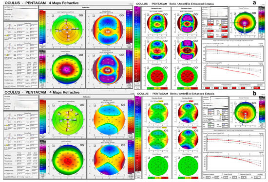 The Role of Pentacam Random Forest Index in Detecting Subclinical ...