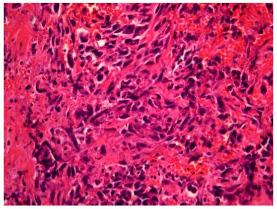 Radiation-Induced Breast Angiosarcoma—A Single-Institution Experience