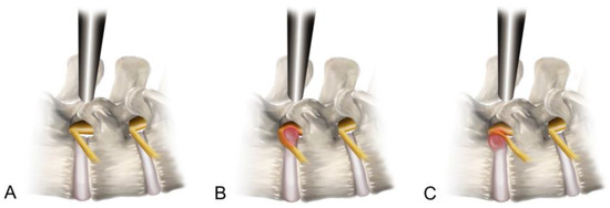 Access Pain During Transforaminal Endoscopic Lumbar Discectomy for ...