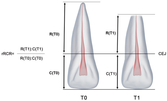 Evaluation of External Apical Root Resorption in Cases with Extraction ...