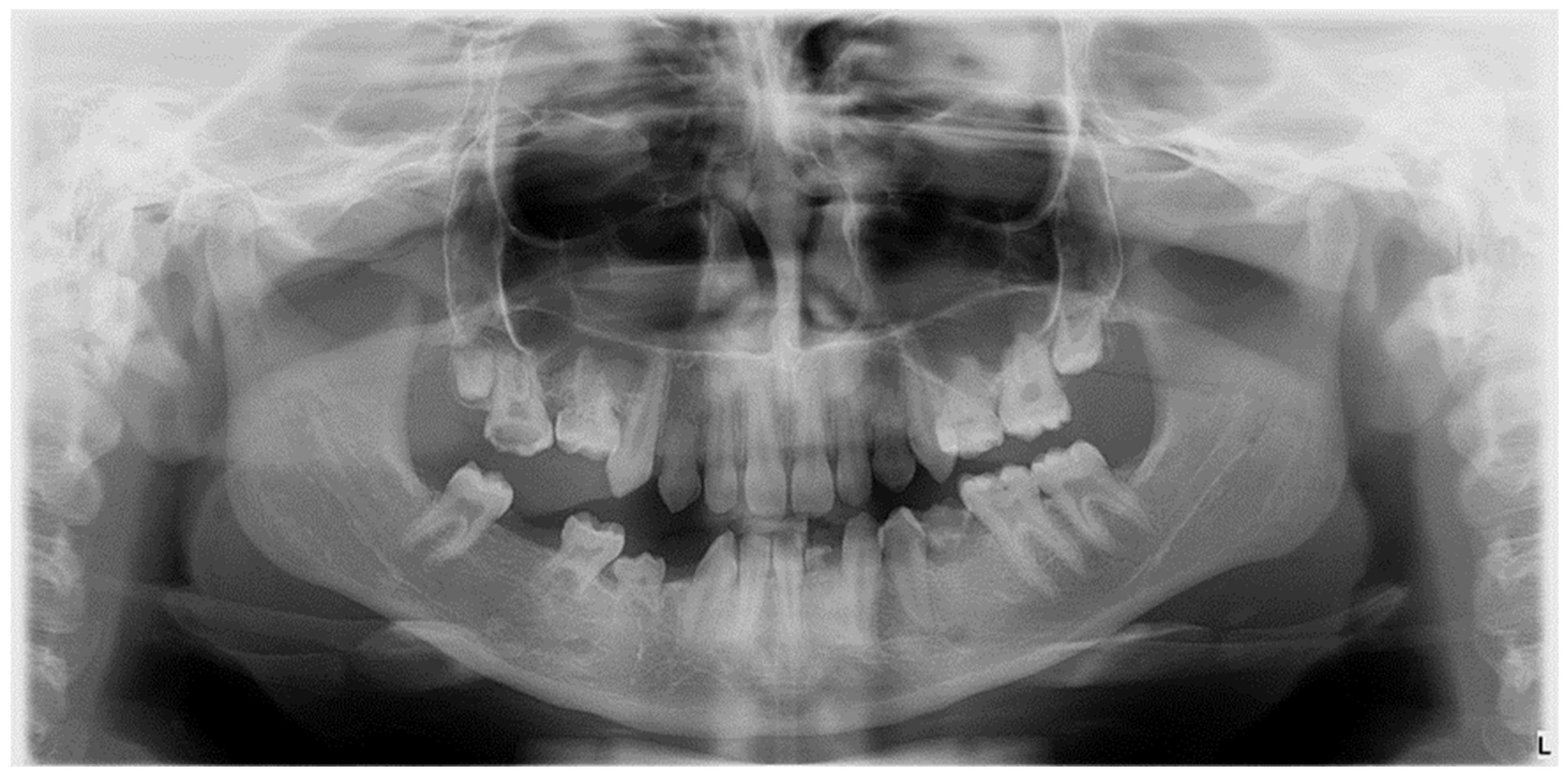 Molar Incisor Hypomineralization: Etiology, Correlation with Tooth ...