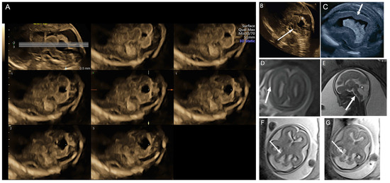 Fetal Cortical Abnormalities Identified on Ultrasound