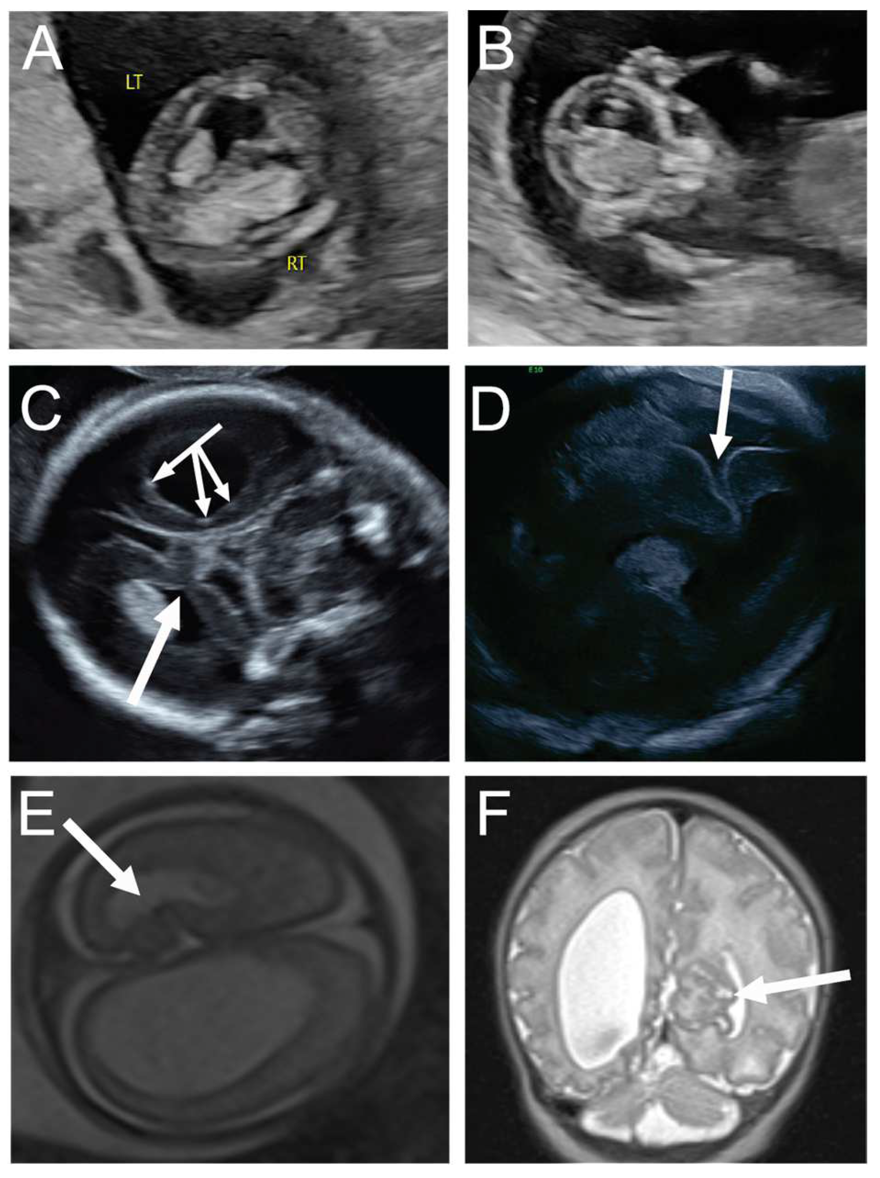 Fetal Cortical Abnormalities Identified on Ultrasound
