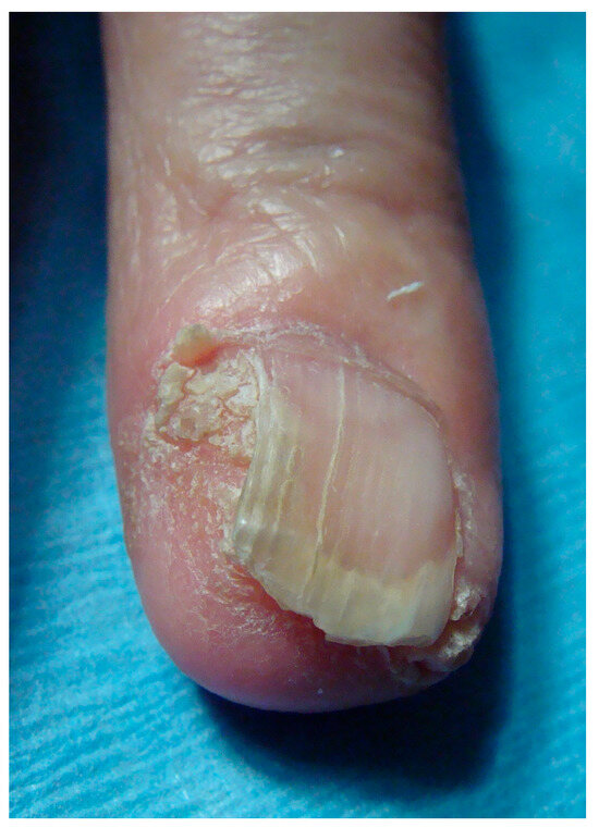 Diagnosis and Management of Malignant Epithelial Nail Unit Tumors