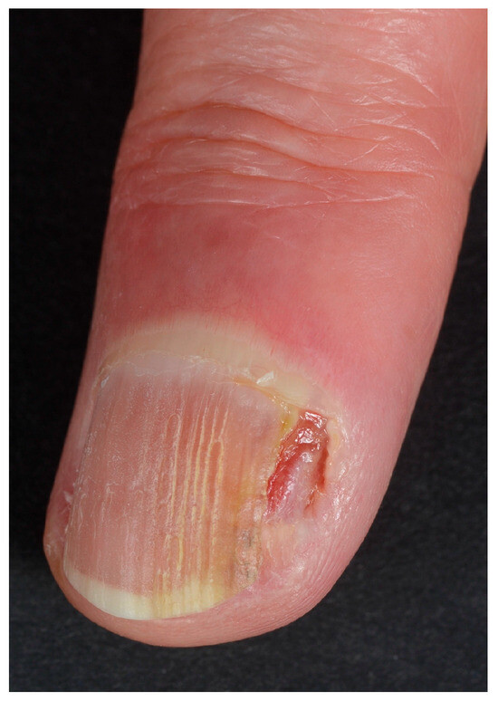 Diagnosis and Management of Malignant Epithelial Nail Unit Tumors