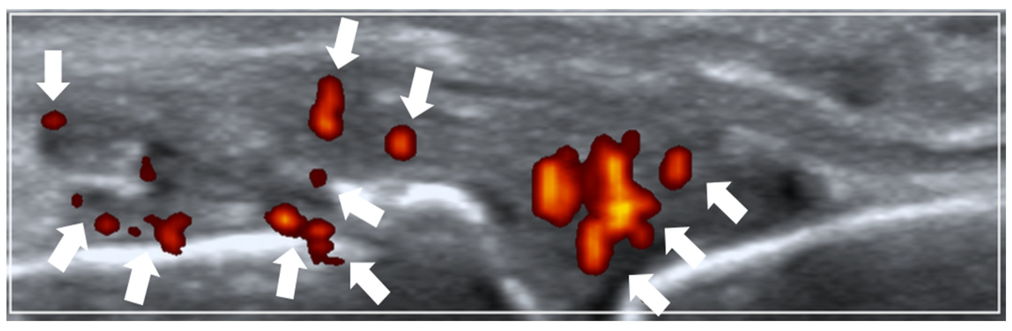 Understanding Ultrasound Power Doppler Synovitis at Clinically ...