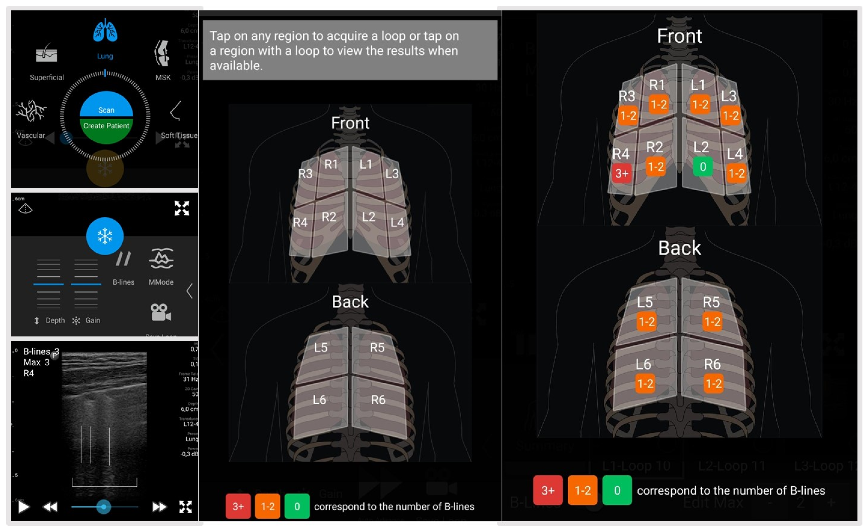 B-Lines in the Assessment of Interstitial Lung Disease Associated with ...