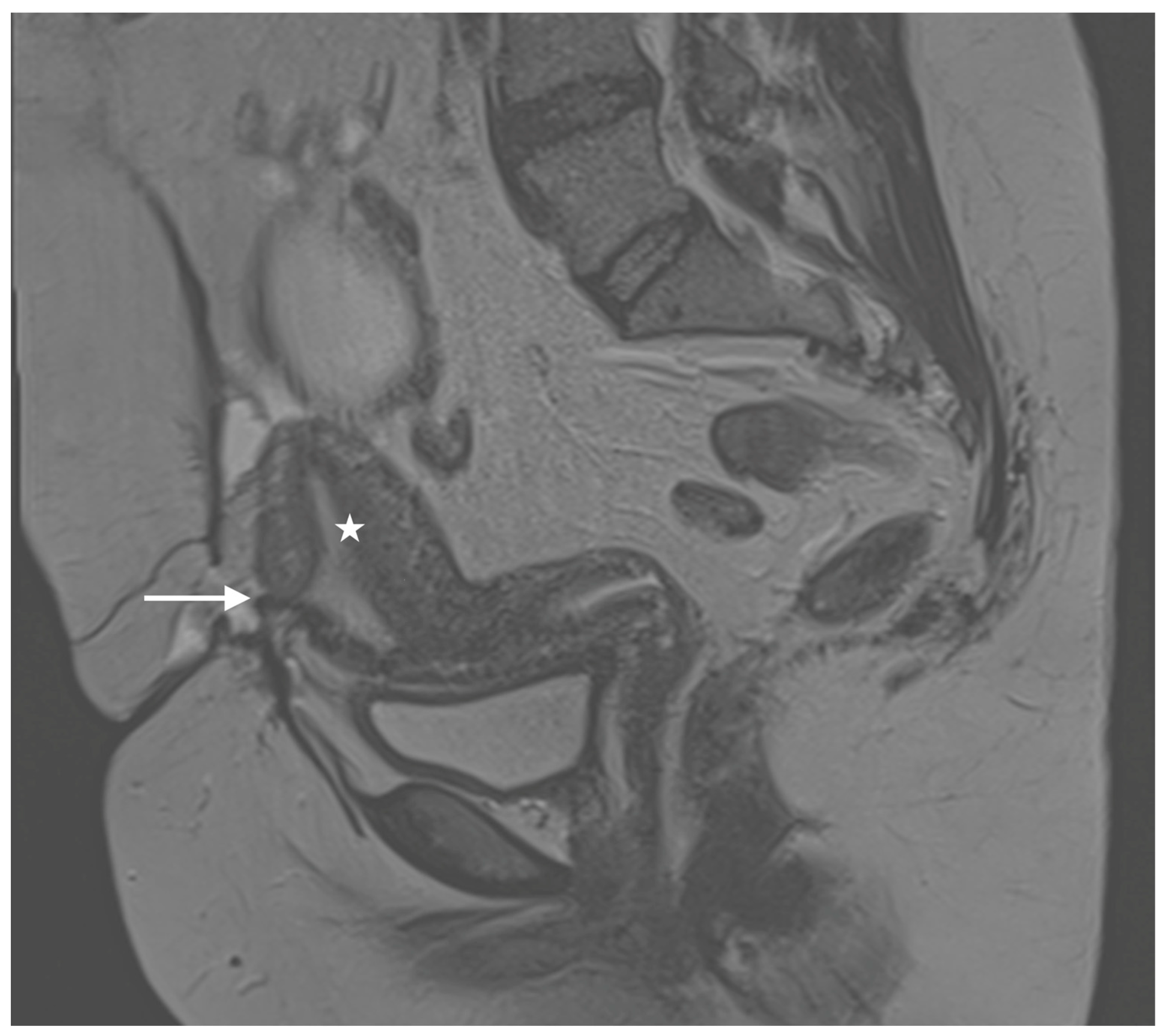 Periodic Bleeding from a Cesarean Section Scar Fistula