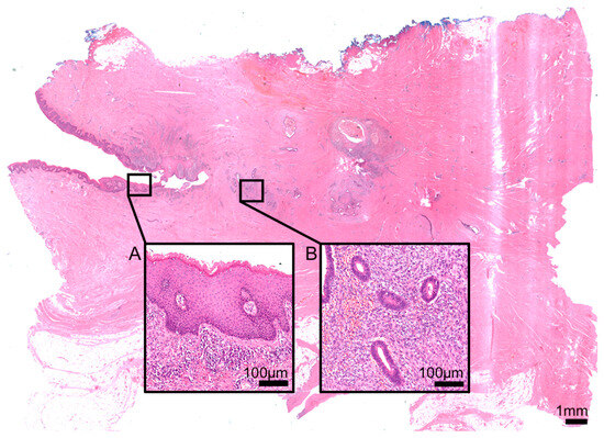 Periodic Bleeding from a Cesarean Section Scar Fistula