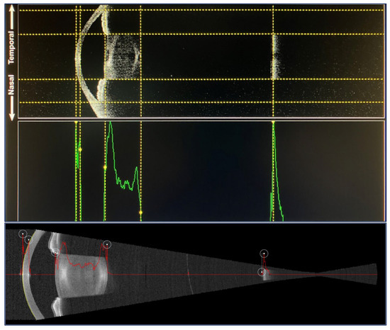 Comparison of Precision, Agreement, and Accuracy of Two Swept-Source ...