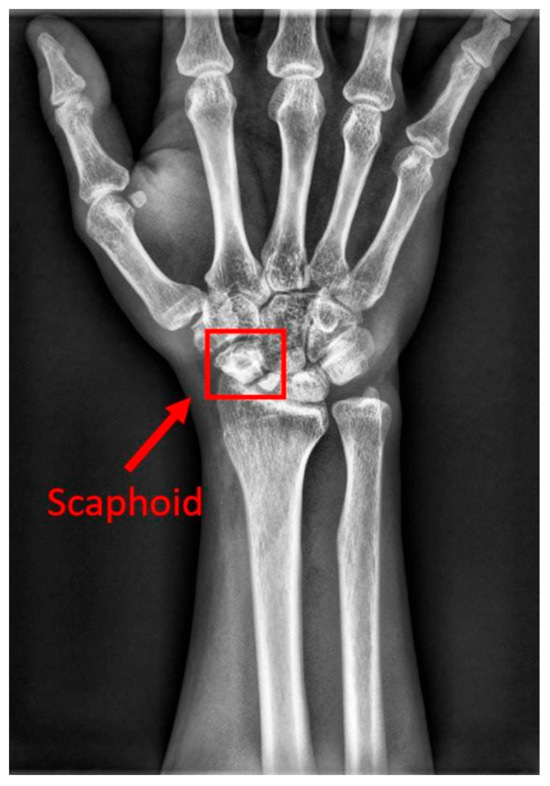 The Detection and Classification of Scaphoid Fractures in Radiograph by ...