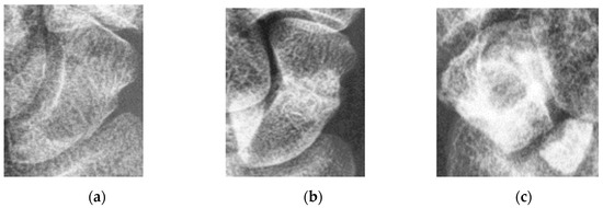 The Detection and Classification of Scaphoid Fractures in Radiograph by Using a Convolutional ...