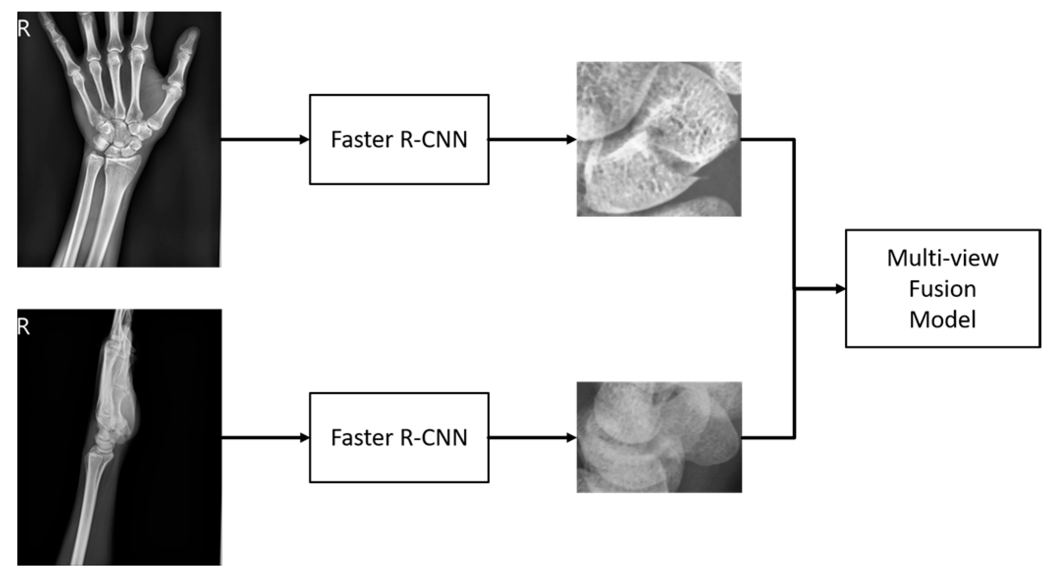 The Detection and Classification of Scaphoid Fractures in Radiograph by Using a Convolutional ...