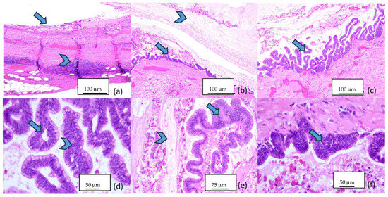 Giant Appendiceal Mucocele with High Grade Mucinous Neoplasm—Case ...