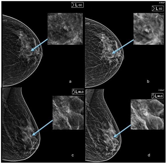 Can Radiologists Replace Digital 2D Mammography with Synthetic 2D ...
