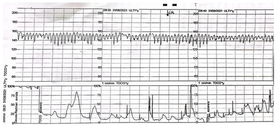 Massive Fetomaternal Hemorrhage Caused by an Intraplacental ...