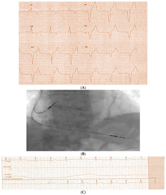 Dual Chamber Pacemaker Implant in Coronary Sinus Leading to Several ...