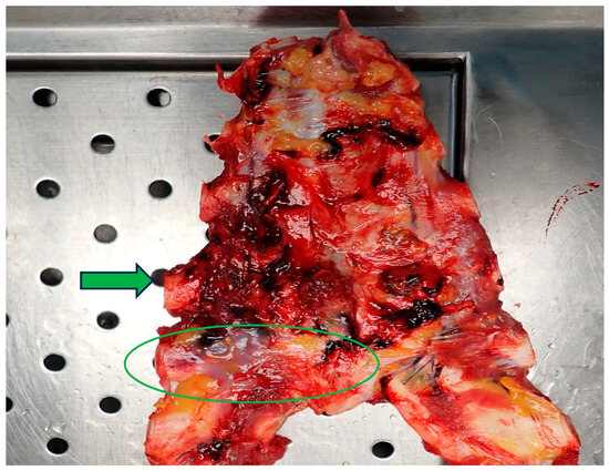 Impact of Cardiac Surgery Scar on Heart Rupture Following a Fall from ...