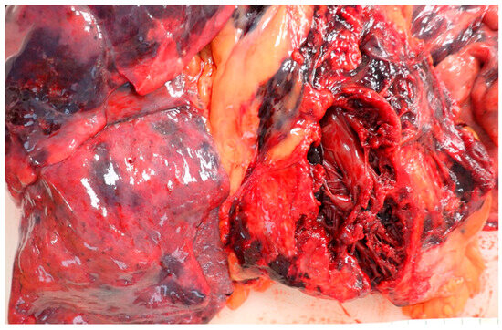 Impact of Cardiac Surgery Scar on Heart Rupture Following a Fall from ...
