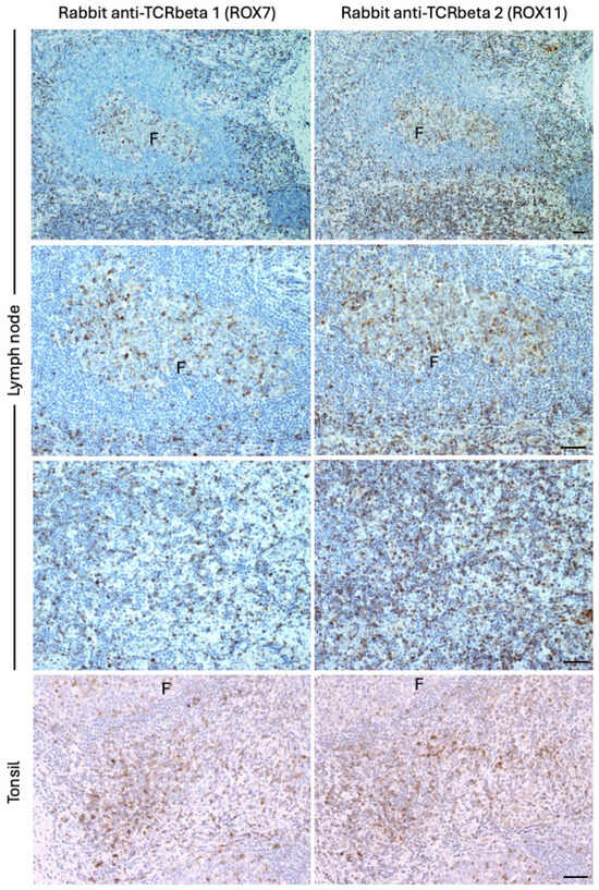 Demonstration of T-Cell Monotypia Using Anti-TCRbeta1/2 (TRBC1/2 ...