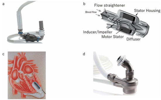 Left Ventricular Assist Device in Advanced Refractory Heart Failure: A ...