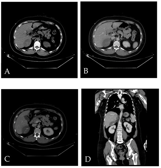 Liver Ischemia After Transarterial Embolization for Hepatic Trauma Injury