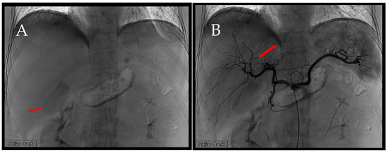 Liver Ischemia After Transarterial Embolization for Hepatic Trauma Injury
