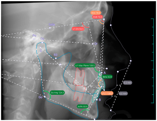 Comparative Analysis of 3D Cephalometry Provided with Artificial ...