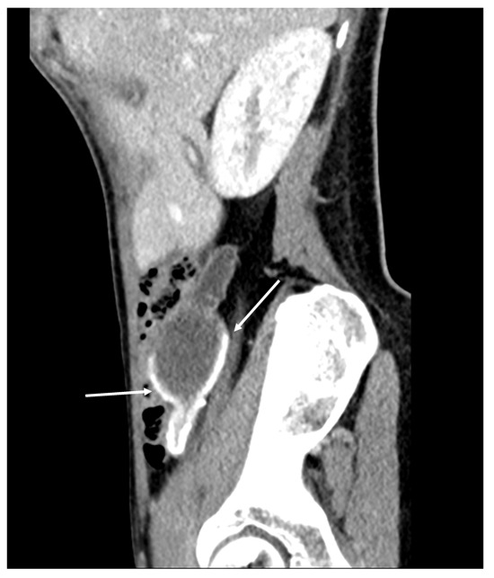 Natural History from Appendiceal Mucocele to Jelly Belly