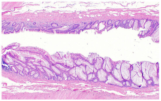 Natural History from Appendiceal Mucocele to Jelly Belly