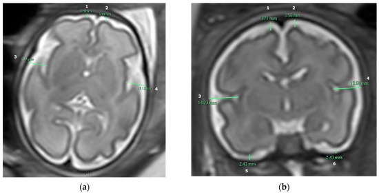 Macrocephaly Mri