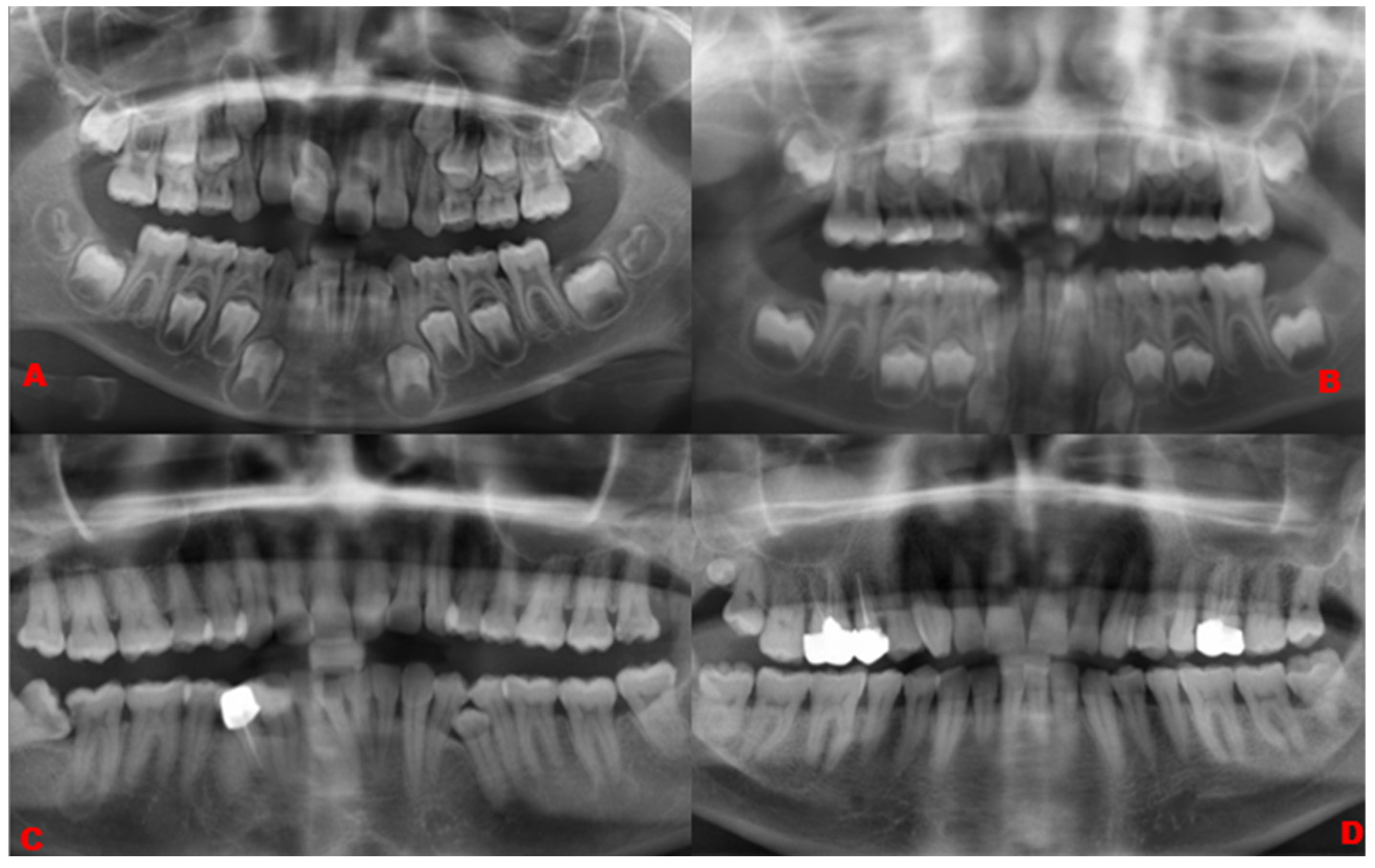 Prevalence, Occurrence, and Characteristics of Supernumerary Teeth ...