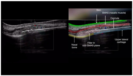 Best Practices for the Use of High-Frequency Ultrasound to Guide ...