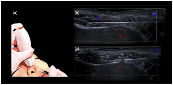 Best Practices for the Use of High-Frequency Ultrasound to Guide ...