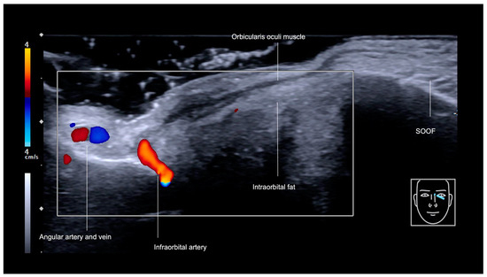 Best Practices for the Use of High-Frequency Ultrasound to Guide ...