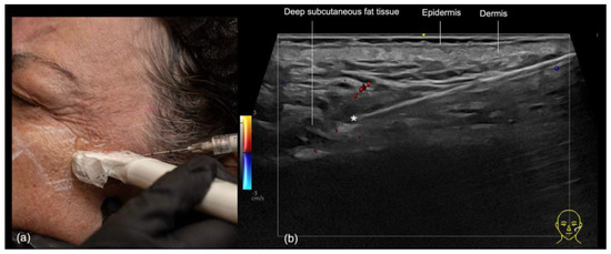 Best Practices for the Use of High-Frequency Ultrasound to Guide ...