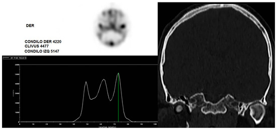 Diagnostic Efficacy of Bone SPECT Techniques in Differentiating ...