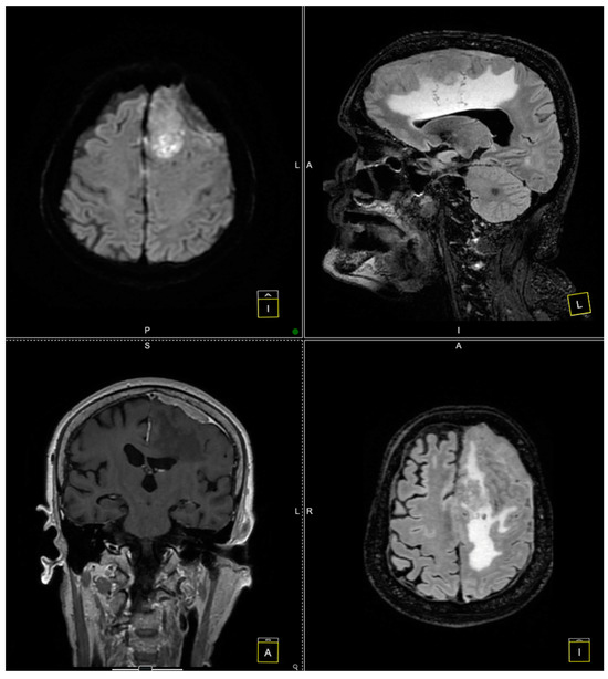 The Management of a Giant Convexity en Plaque Anaplastic Meningioma ...