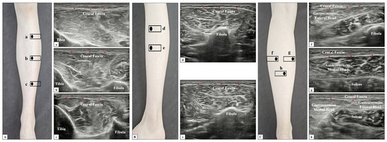 Ultrasound Imaging Comparison of Crural Fascia Thickness and Muscle ...
