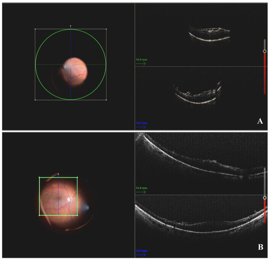 Intraoperative OCT-Guided Selective Epiretinal Membrane (ERM) Peeling ...