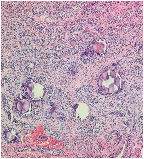 Persistent Müllerian Duct Syndrome with Supernumerary Testicles Due to ...