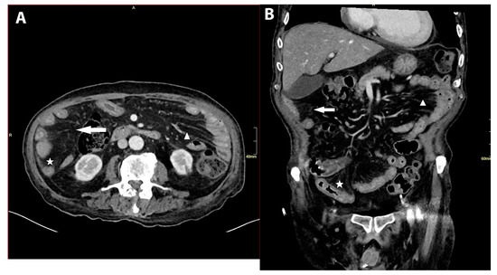 Cytomegalovirus Enterocolitis in a Patient Treated with ...