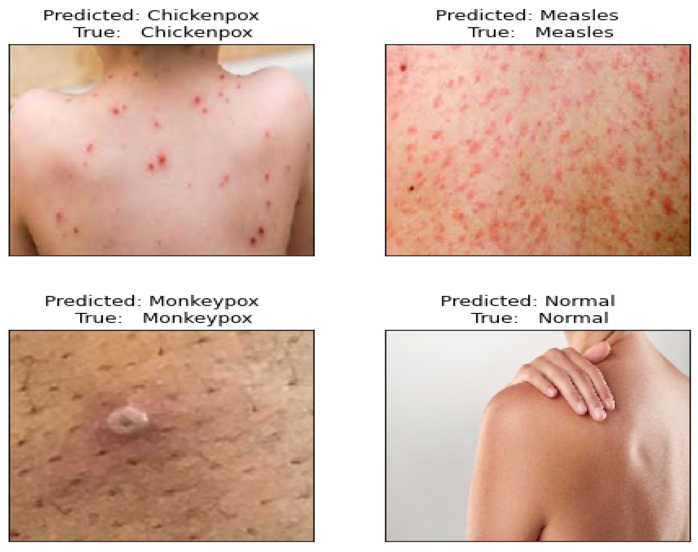 TMS: Ensemble Deep Learning Model for Accurate Classification of Monkeypox Lesions Based on ...