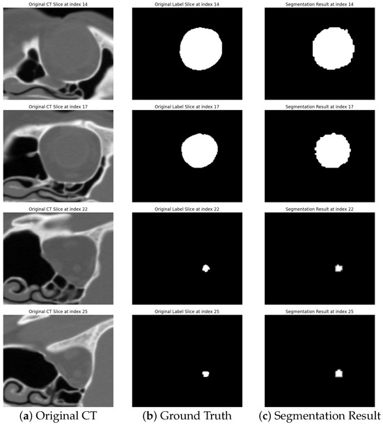 Segmentation-Based Measurement of Orbital Structures: Achievements in ...