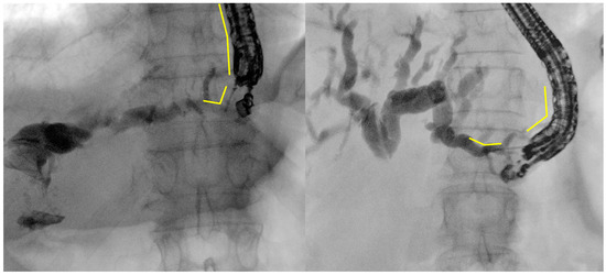 Endoscopic Ultrasound-Guided Hepaticogastrostomy in Malignant Biliary ...