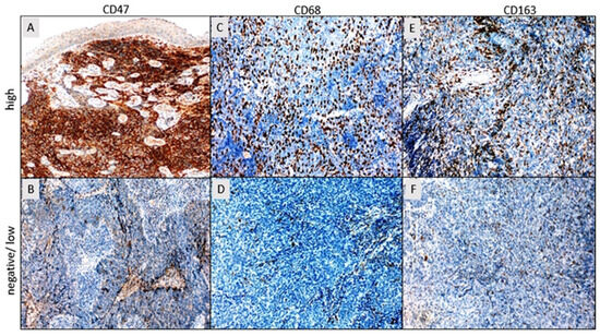 The Prognostic Significance of CD47, CD68, and CD163 Expression Levels ...