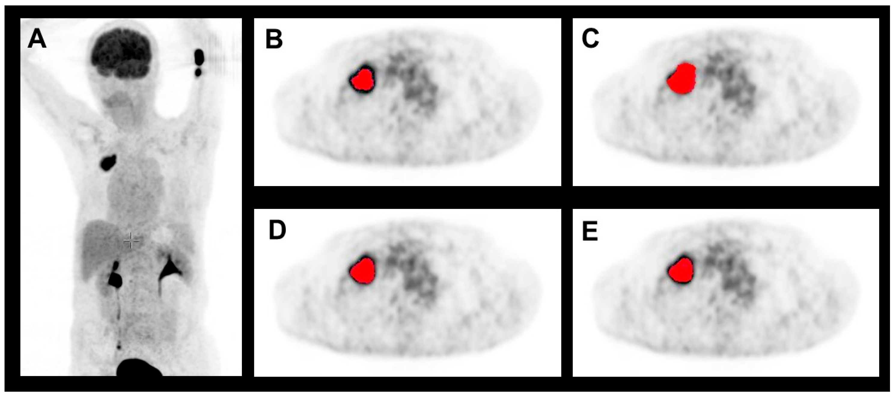 A Tumor Volume Segmentation Algorithm Based on Radiomics Features in FDG-PET in Lung Cancer ...